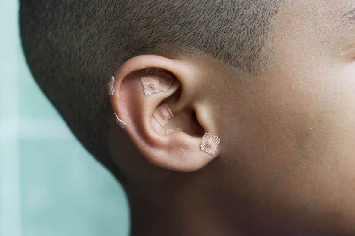 What Is Ear Seeding And Its Benefits To Beauty OhDaisey
